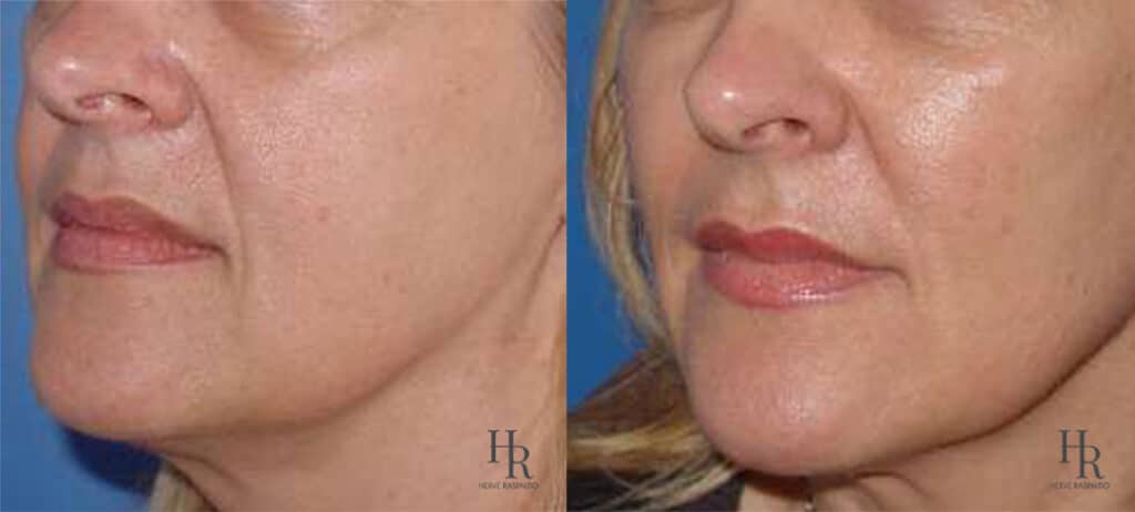 Injection acide hyaluronique Avant / après | Dr Raspaldo | Genève