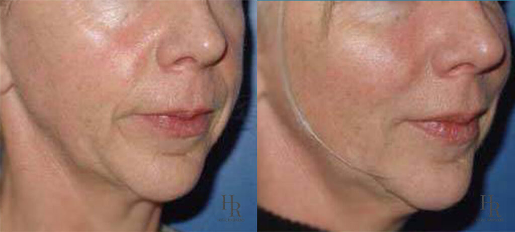 Injection acide hyaluronique Avant / après | Dr Raspaldo | Genève