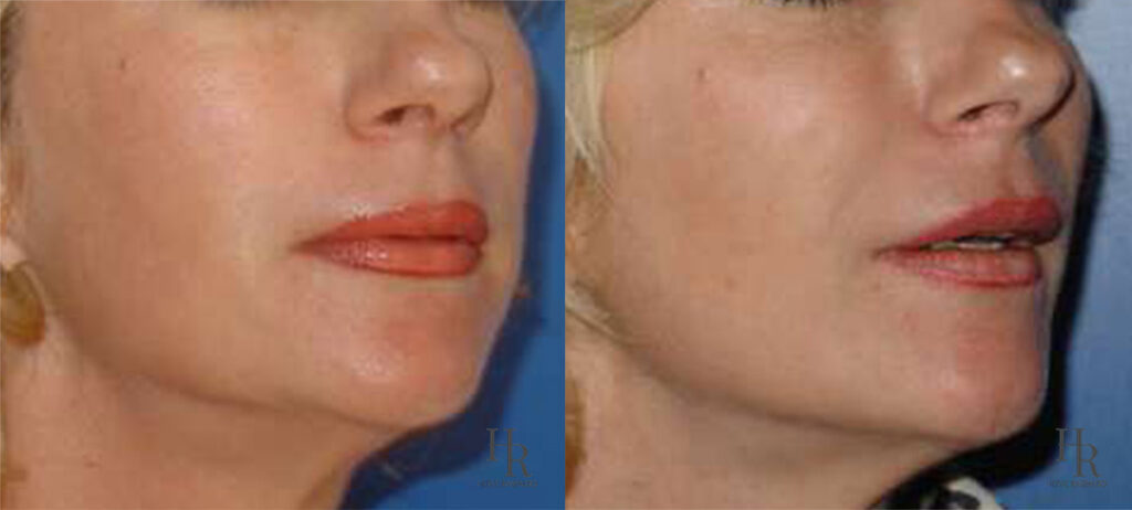 Injection acide hyaluronique Avant / après | Dr Raspaldo | Genève