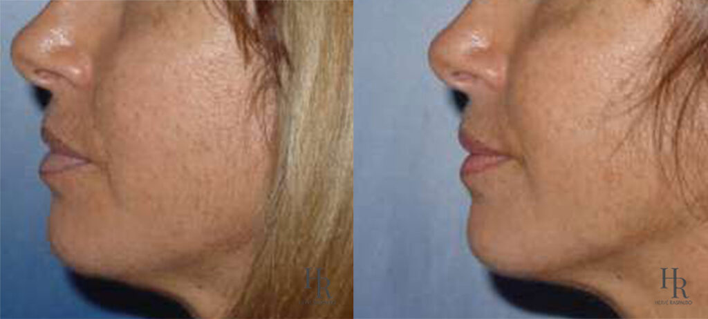 Injection acide hyaluronique Avant / après | Dr Raspaldo | Genève