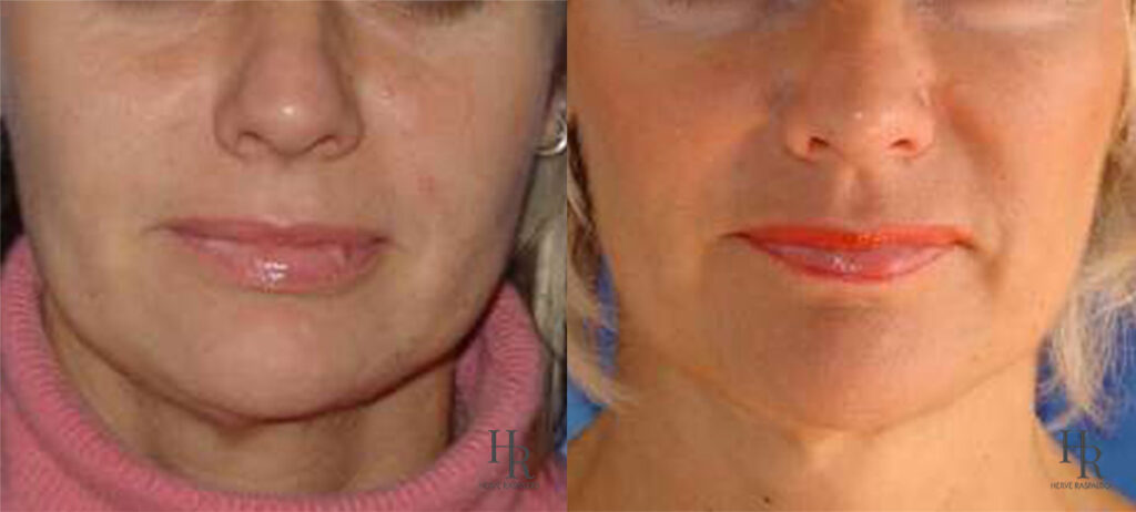 Injection acide hyaluronique Avant / après | Dr Raspaldo | Genève