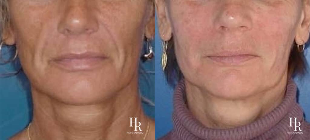 Injection acide hyaluronique Avant / après | Dr Raspaldo | Genève