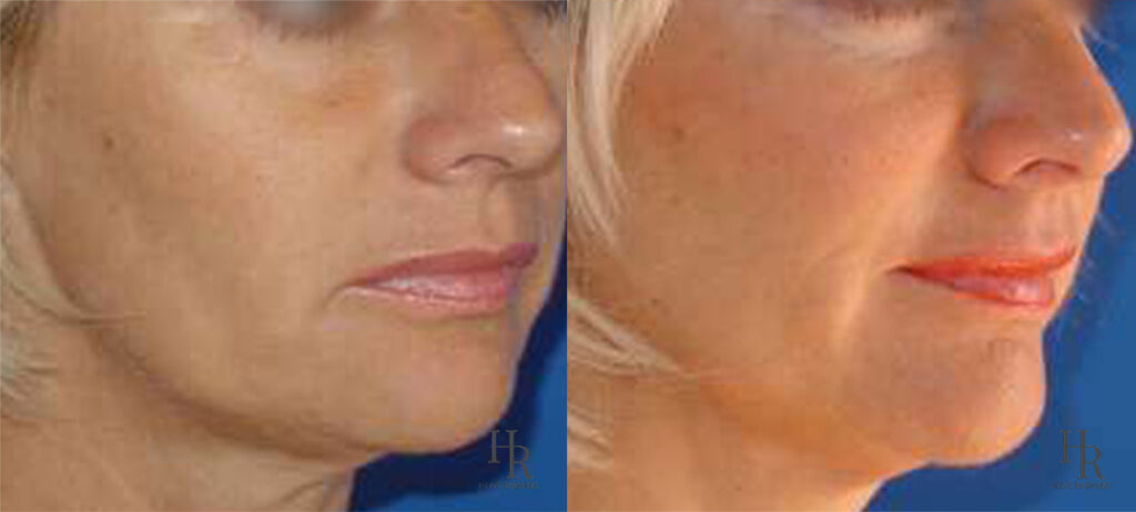 Injection acide hyaluronique Avant / après | Dr Raspaldo | Genève