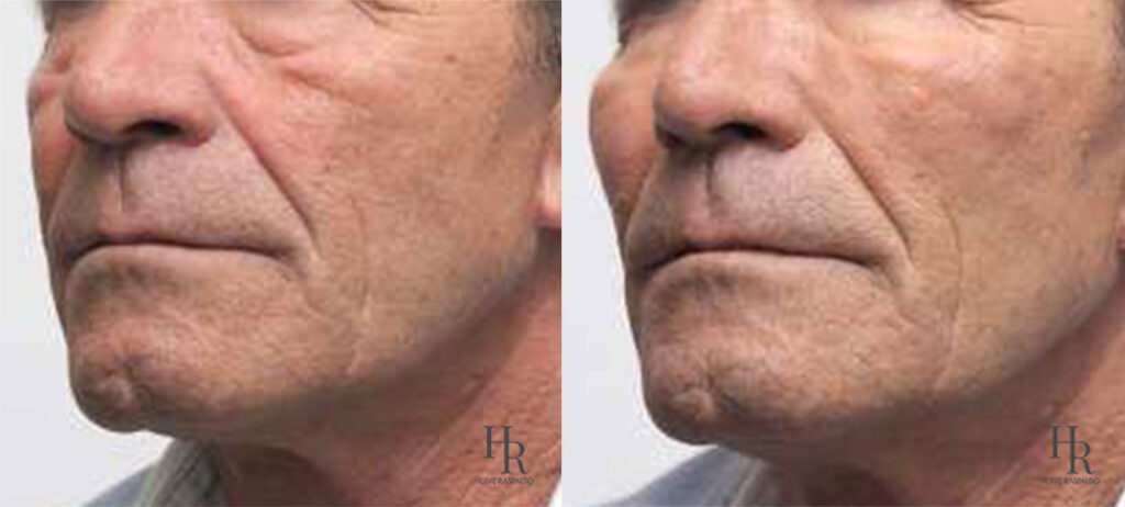 Injection acide hyaluronique Avant / après | Dr Raspaldo | Genève