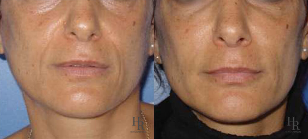 Injection acide hyaluronique Avant / après | Dr Raspaldo | Genève