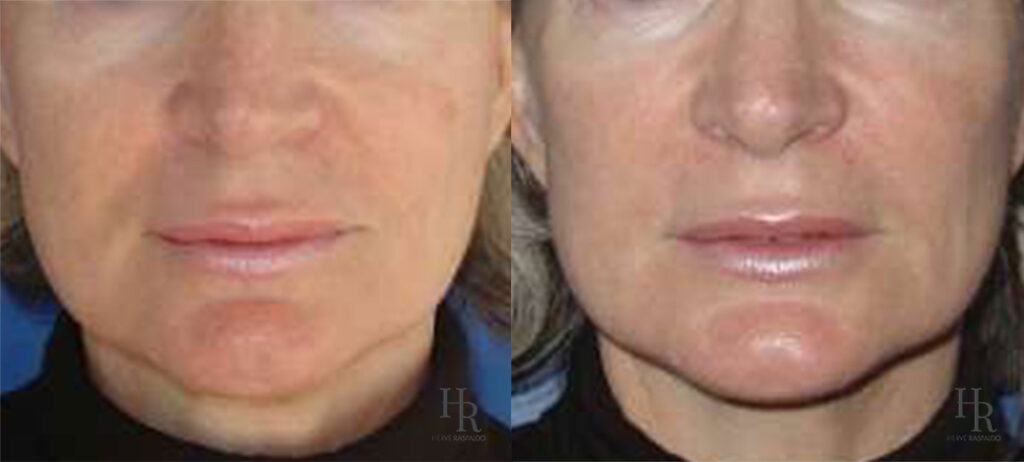 Injection acide hyaluronique Avant / après | Dr Raspaldo | Genève