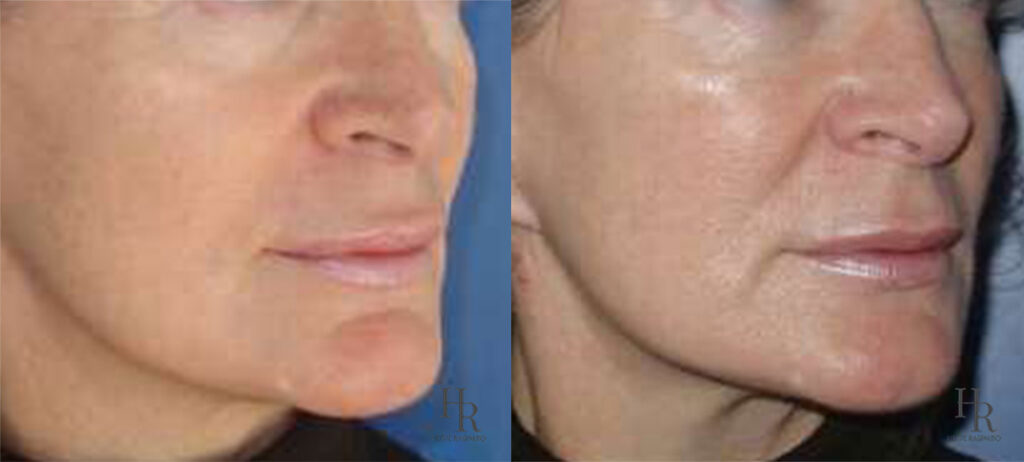 Injection acide hyaluronique Avant / après | Dr Raspaldo | Genève
