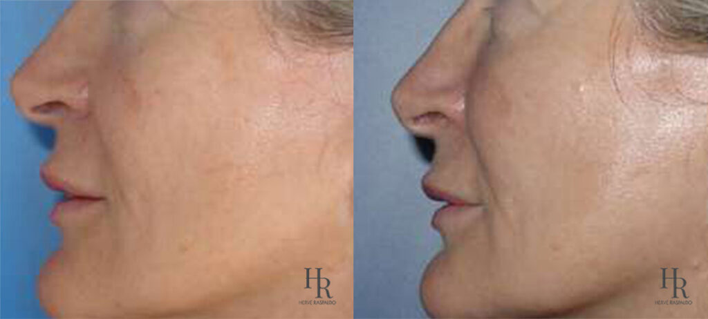 Injection acide hyaluronique Avant / après | Dr Raspaldo | Genève