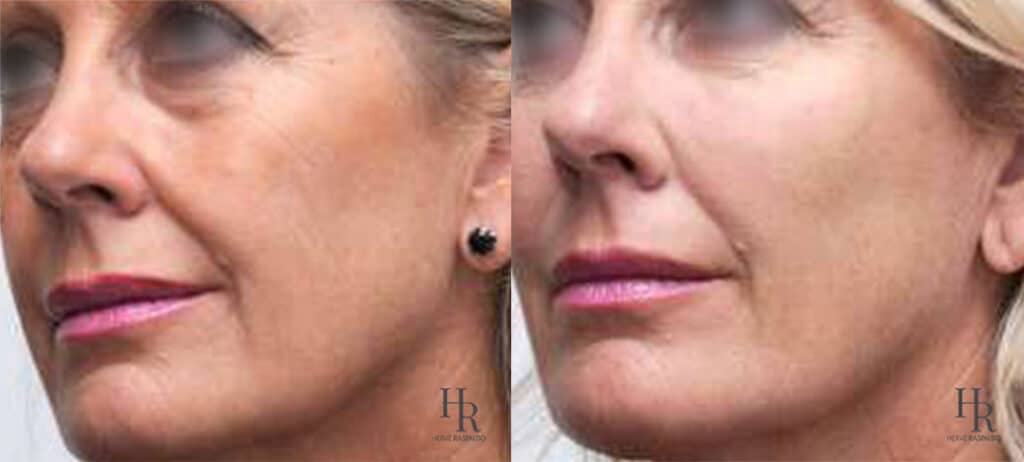 Injection acide hyaluronique Avant / après | Dr Raspaldo | Genève