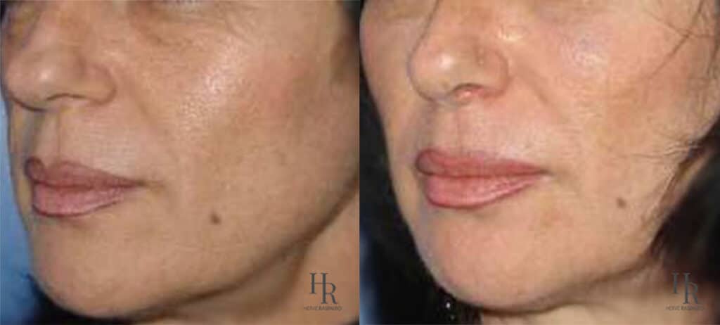 Injection acide hyaluronique Avant / après | Dr Raspaldo | Genève