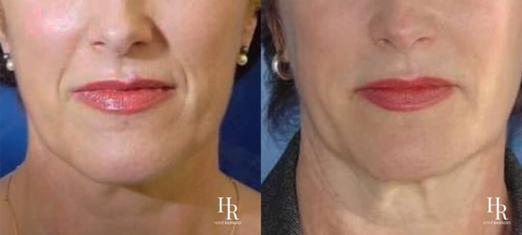 Injection acide hyaluronique Avant / après | Dr Raspaldo | Genève