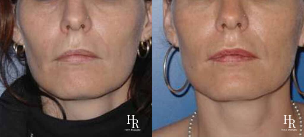 Injection acide hyaluronique Avant / après | Dr Raspaldo | Genève