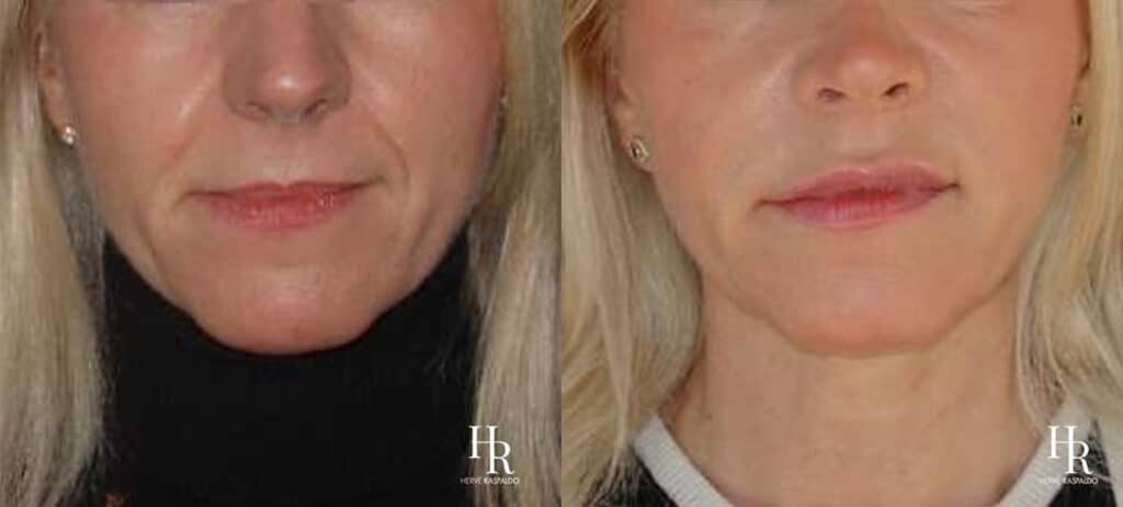 Injection acide hyaluronique Avant / après | Dr Raspaldo | Genève