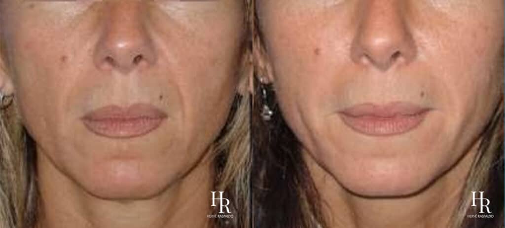 Injection acide hyaluronique Avant / après | Dr Raspaldo | Genève